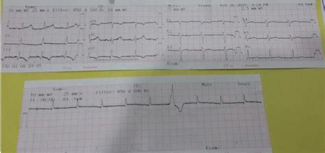 Electrocardiogram Showing T Inversion In Iii Avf And Occasional