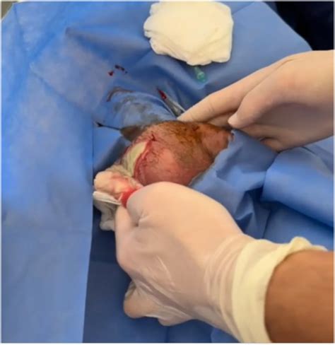 Scrotal Abscess Caused By Candida Glabrata In A Patient With