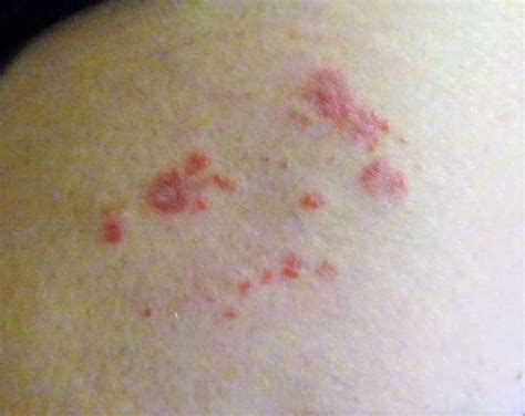 Tests For Shingles Without Rash