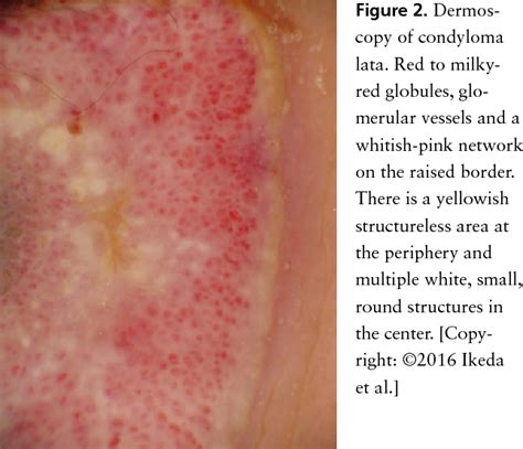 Condylomata Lata Semantic Scholar