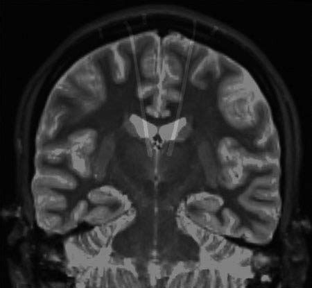 Postoperative Computed Tomography CT Magnetic Resonance Imaging MRI