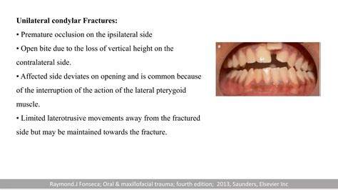 Condylar Fracture Pptx
