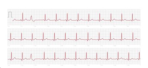 Wifes Ecg Results During Repeated “flutters” Rmedical