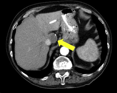 Ct View Before Radiofrequency Ablation Showing 27 Â 26 Caudate Lobe Download Scientific