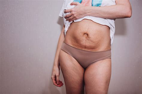 Do Stretch Marks Come From Losing Or Gaining Weight Rejûvaskin