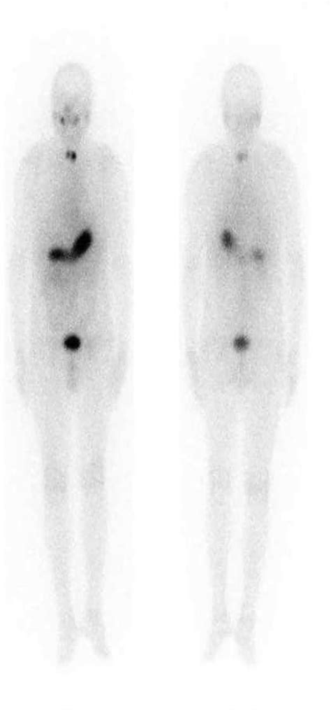 Lymph Node Metastases Tg 846 Ngml Download Scientific Diagram