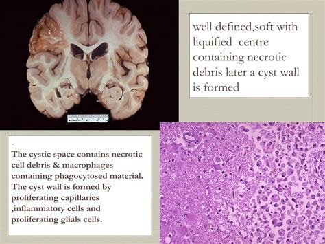 Necrosis And Gangrene Pathology Calcification Ppt