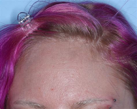 Before And After Photos Zoryve® Foam For Plaque Psoriasis