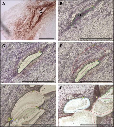 Figure 1 From Differential Tgfb1 Signalling In Endometrium From Women