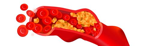Lipoprotein A Marker To Identify Heart Attack Risk Happiest Health