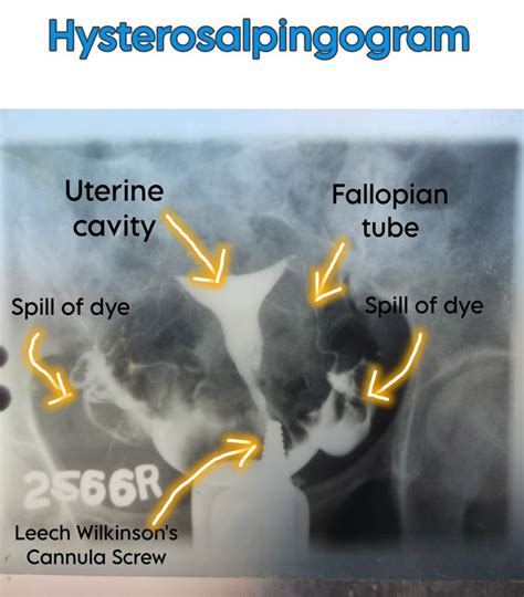 Hysterosalpingogram Labelled Real Image Fallopian Tubes Cavities Real