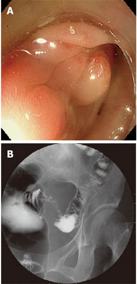 Difficulty In Differentiating Two Cases Of Sigmoid Stenosis By
