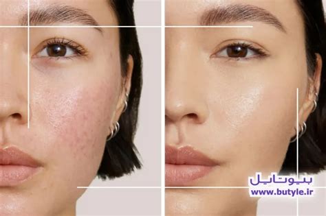 تینت پوست چیست؟ بررسی کامل مزایا، معایب و طرز استفاده تینت