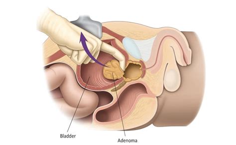 Prostate Surgery In Navi Mumbai Mitr Urology