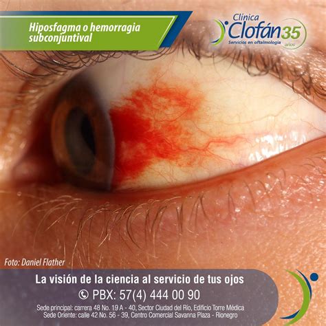 Clínica Clofán La Hemorragia Subconjuntival Ocurre Cuando Se Rompen