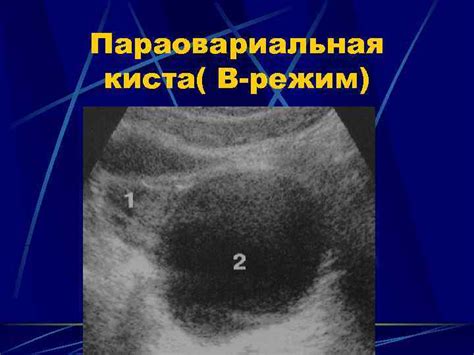 УЗД образований яичников Е О Богданова кафедра рентгенологии