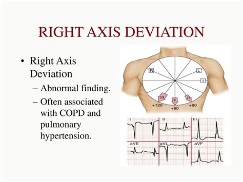 Twelve Lead Interpretation Ppt Download