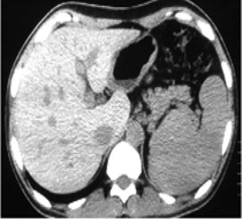 Juvenile Hemochromatosis Wikiprojectmed