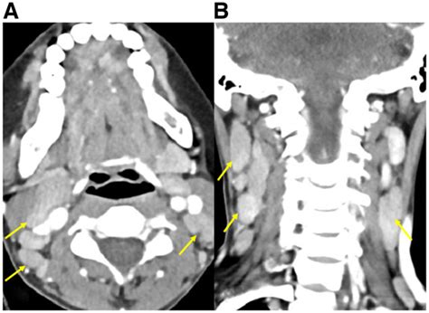 Contrast Enhanced Computed Tomography Scan Of The Neck Of A