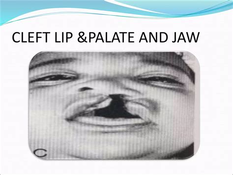 Development Of Palateppt
