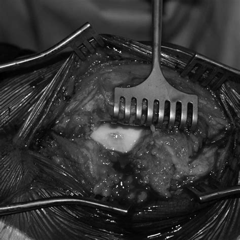 Intraoperatively The Lesion Demonstrated Hypertrophied Synovium With