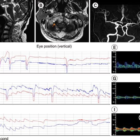Cervical Magnetic Resonance Imaging Mri Saggital View Shows C1