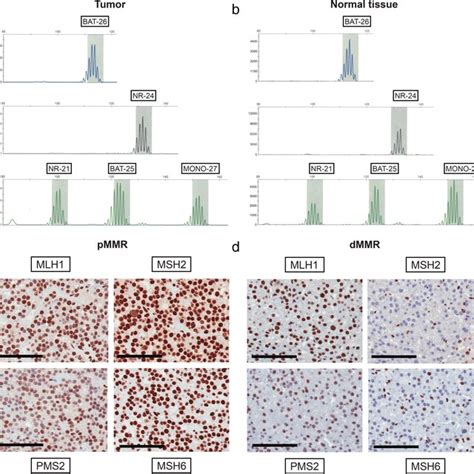 Microsatellite Instability‐polymerase Chain Reaction Msi‐pcr Analysis
