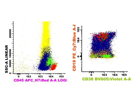 Pathology Outlines Aml With T821q22q22 Runx1runx1t1
