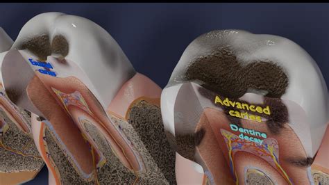 Caries Teeth Severity Schematic Cut Sectional Superhive Formerly