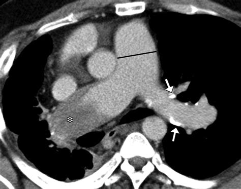 Ct Diagnosis Of Chronic Pulmonary Thromboembolism Radiographics