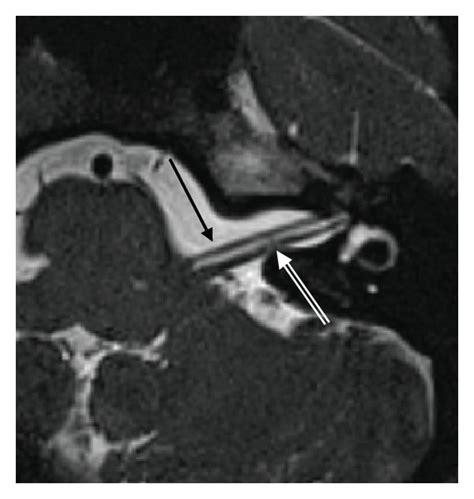 Normal Facial Nerve On Mri A Axial Ciss Image At The Level Of The Download Scientific