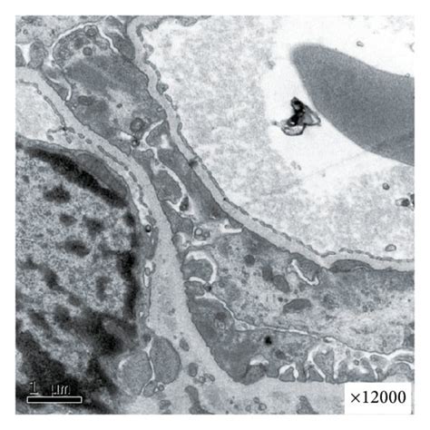 Electron Microscopy Irregular Thickening Of The Gbm And The Fusion Of Download Scientific