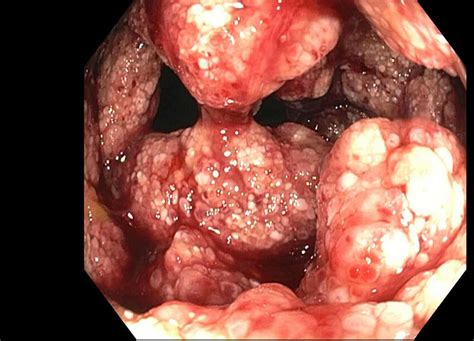 A Push Enteroscopy Endoscopy Showing A Large Fungating Mass Found In Download Scientific