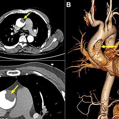 Intraoperative Macroscopic Findings A A Sessile Mass Was Seen Attached