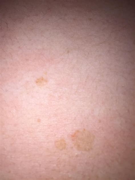 Skin Concerns Strange Permanent Little Spots Have Appeared On My
