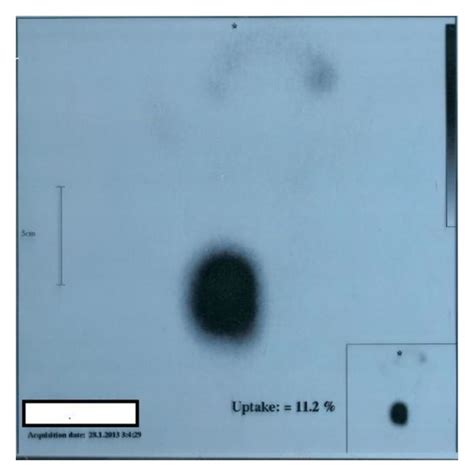 Technetium Thyroid Scan Showing Autonomous Hot Nodule With Download Scientific Diagram