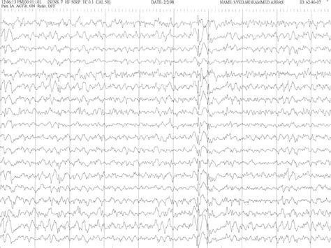 Abnormal Eeg Patterns Ppt