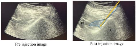 Ultrasound Scan Of Ipack Block With Spread Of Local Anaesthetic S Download Scientific