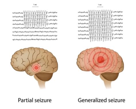 Bilateral Tonic Clonic Seizures The Defeating Epilepsy Foundation