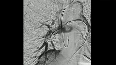 Advancing Percutaneous Treatment Of Pulmonary Embolism With Computer Assisted Vacuum Thrombectomy