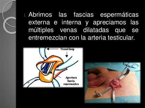 Varicocelectomía