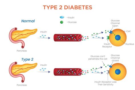 Type 2 Diabetes Causes Symptoms And Management Strategies 53212706