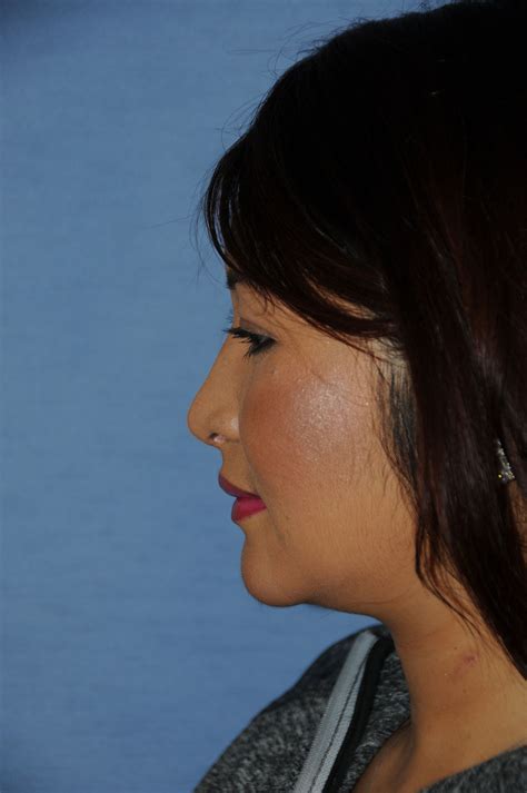 Rhinoplasty Anatomy