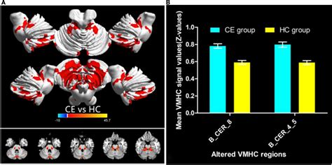 Frontiers Altered Homotopic Connectivity In The Cerebellum Predicts Stereopsis Dysfunction In