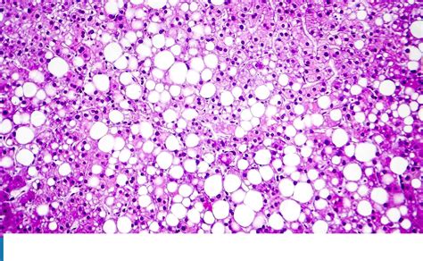 Reversible Cell Injury Mechanism And Morphology