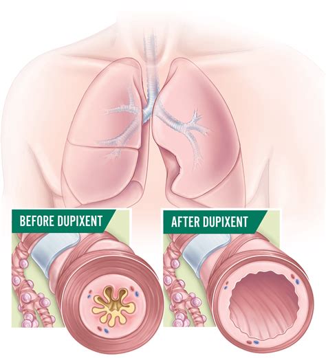How Dupixent® Dupilumab Works For Asthma