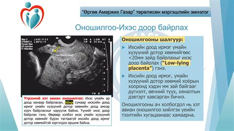 Ихэс түрүүлэлт Placenta Previa Pptx
