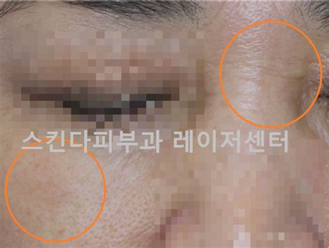 안면 부분 혈관확장증 거미 혈관종의 레이저 치료 네이버 블로그