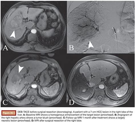 Chemoembolization With Drug Eluting Beads Radiology Key