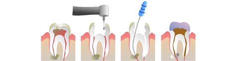 Endodontic Treatment Plumstead Dental Care